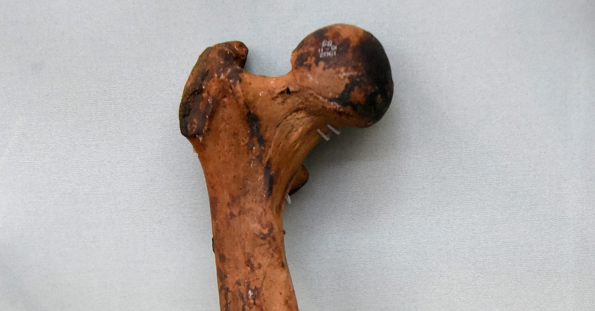 Fractured Femur of an Egyptian Mummy - World History Encyclopedia